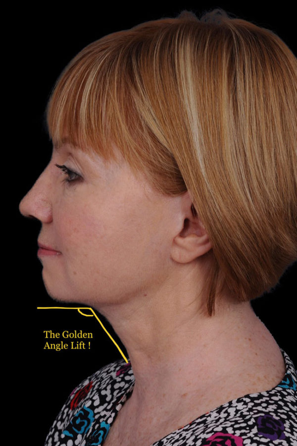 Sculpting the Jawline: A youthful jawline makes for a youthful face ...